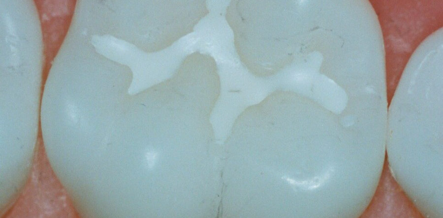 FISSURE SEALANTS - VitaSmile
